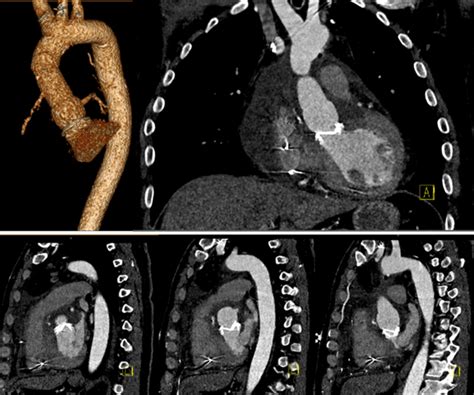 Feasibility Of Low Seated Composite Aortic Conduit For Surgical