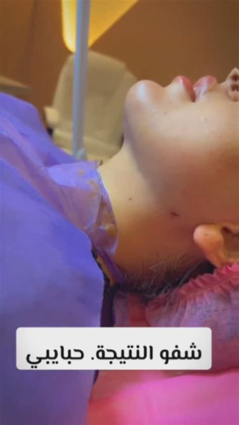 Dr Oubeid ‎هل سمعتِ عن تقنية تضييق المهبل بالليزر؟ 💡 الآن يمكنكِ