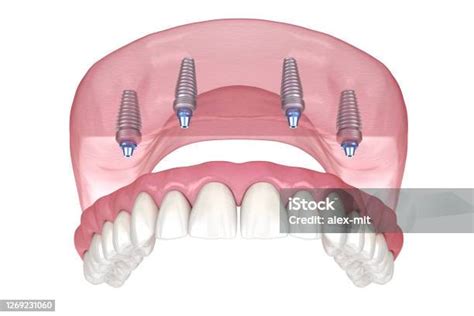 임플란트에 의해 지원되는 4 시스템에 잇몸 모두와 상악 보철 인간의 치아와 의치의 의학적으로 정확한 3d 그림 임플란트에 대한 스톡 사진 및 기타 이미지 Istock