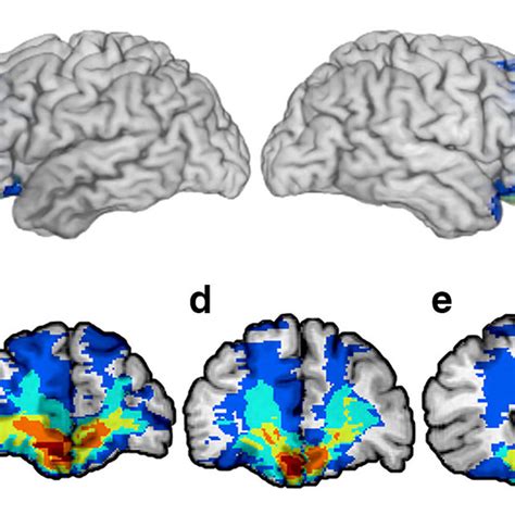 Neuroanatomy Of The Vmpfc Group Lesion Overlap Was Concentrated In The Download Scientific