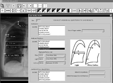 Evaluation Of Three Pneumothorax Size Quantification Methods On