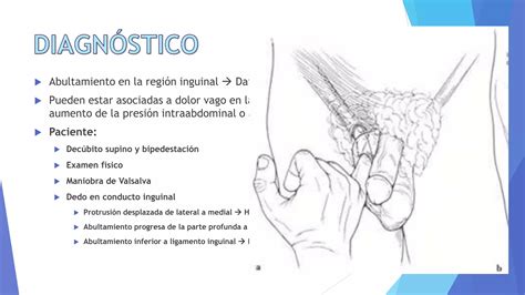 Hernia Inguinal Y Crural Pptx