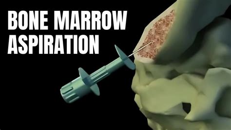 Bone Marrow Biopsy Steps
