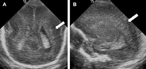 Periventricular Leukomalacia A Coronal Neurosonogram Of A Preterm