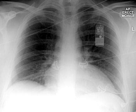 Implantable Loop Recorder Removal Hoeu