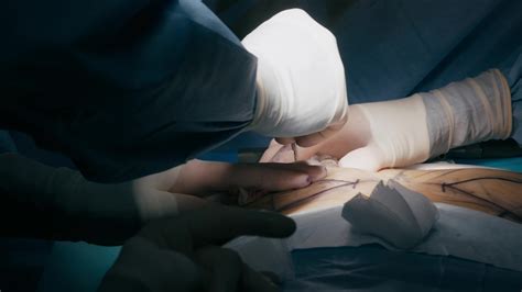 Liposuction Surgery The Doctor Prepares To Collect Fat From The Womans Belly Body Preparing