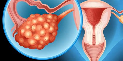40 Facts About Peritoneal Inclusion Cyst