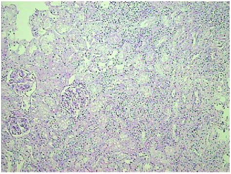 Patchy Inflammatory Infiltrate Between The Cortical Tubules Without Download Scientific