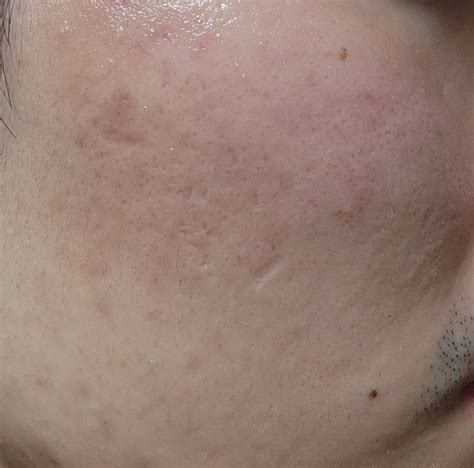 여드름 패인 흉터 지식in