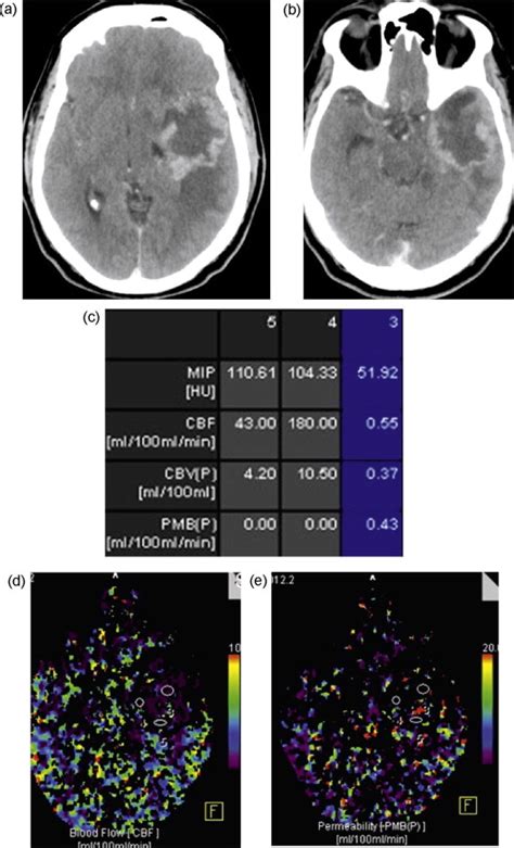 Year Old Male Presented With GBM A And B Early And Late Dynamic Download Scientific