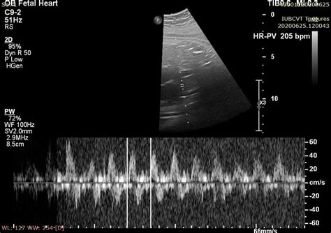 Pulsed Doppler Echocardiogram From The Fetus Download Scientific Diagram