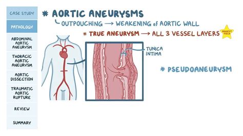 Video Aortic Dissections And Aneurysms Pathology Review Osmosis