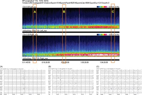 Quantitative Eeg Basics Seizure Detection And Avoiding Pitfalls Neupsy Key