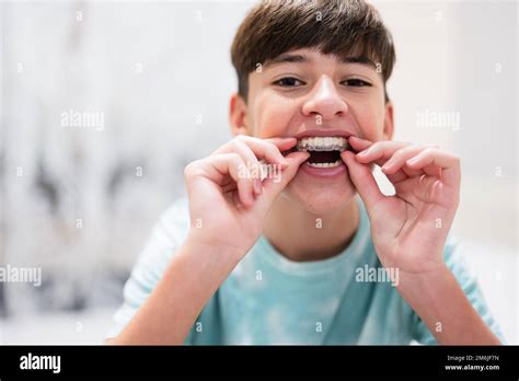 Teenager Boy Wear Simulator Orthodontic Silicone Invisible Leveling Braces For Teeth Dental