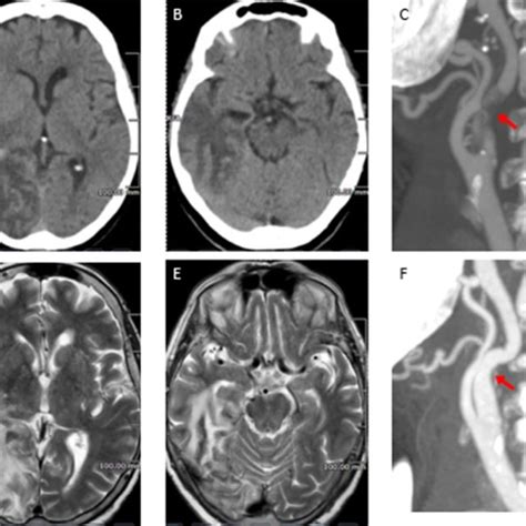 Case N A B Brain Computed Tomography CT Revealing Right Download Scientific Diagram