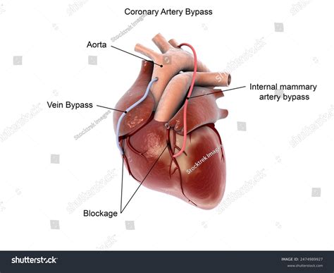 Coronary Artery Bypass Human Heart Stock Illustration 2474989927