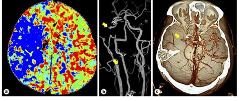 A Computed Tomography Perfusion Scan Before Thrombectomy Hypoperfusion Download Scientific
