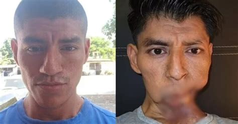 턱 90 잘라내작은 혹에서 축구공 크기로 이 암 걸린 男 사연은