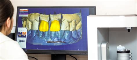 4 Steps For 3d Printing Dental Crowns