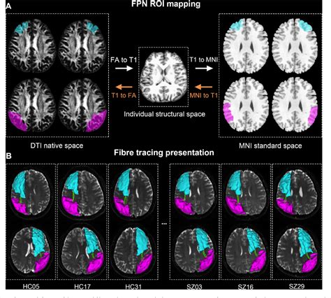 Table 1 From Structural Abnormalities In The Fronto Parietal Network Linking White Matter