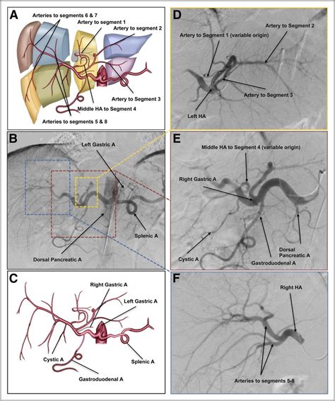 From The Angio Suite To The γ Camera Vascular Mapping And 99mtc Maa Hepatic Perfusion Imaging