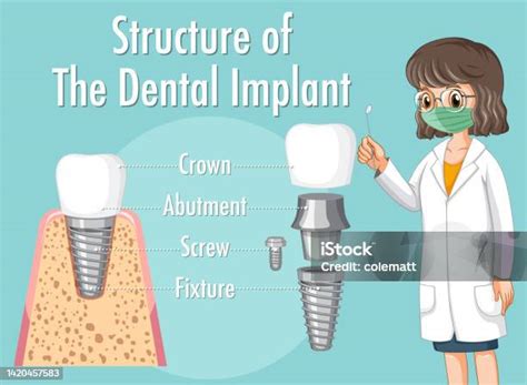 치과 임플란트의 구조에서 인간의 인포 그래픽 가정용 시설에 대한 스톡 벡터 아트 및 기타 이미지 가정용 시설 교육 나사 Istock