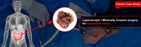 Laparoscopic Minimally Invasive Surgery For Mesenteric Tumor Lpc Mumbai