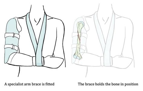 Mid Shaft Humerus Fracture Treatment