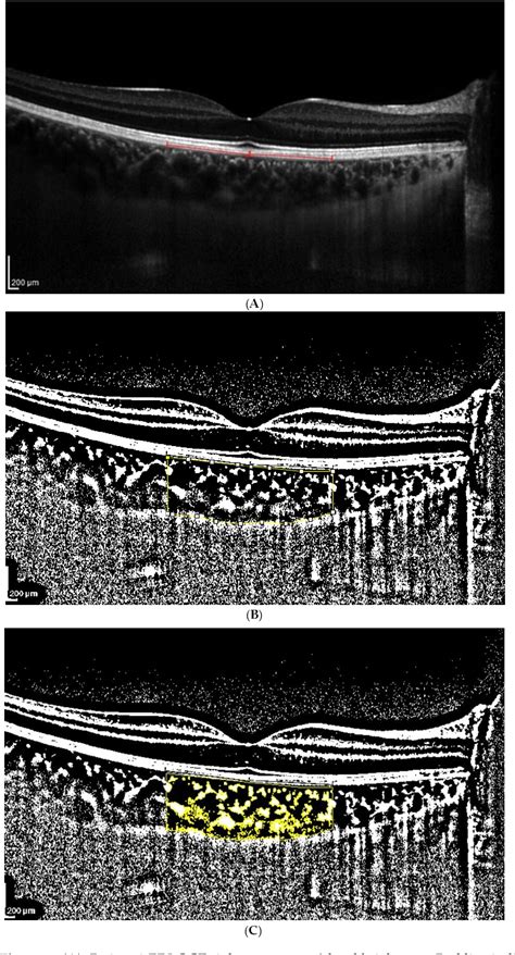 Figure 1 From Impact Of Brightness On Choroidal Vascularity Index