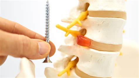 Adjacent Segment Degeneration After Spine Fusion Surgery Regenerative Spine And Joint