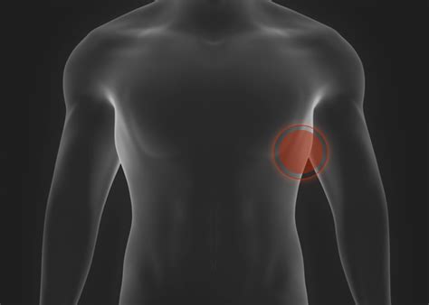 Intercostal Sprain Bruised Rib T E A M Clinic®