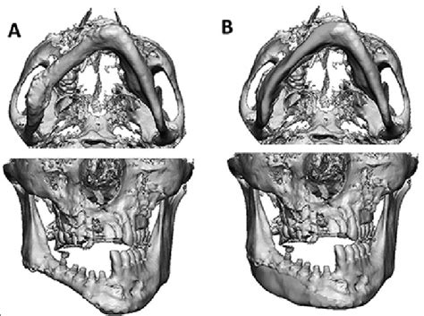 3d Reconstruction Of The Craniofacial Skeleton Actual Inferior View