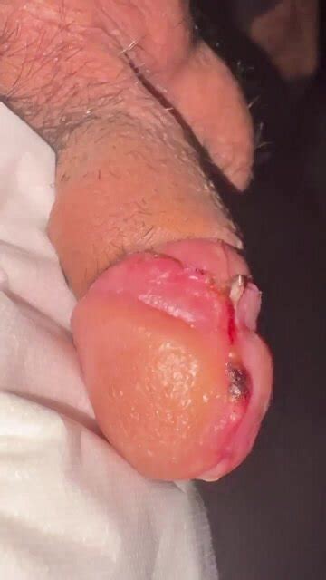 Just Got Circumcised Fresh Circumcision