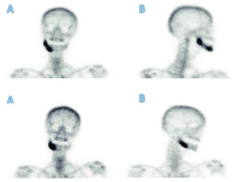 Osteomyelitis Bone Scan