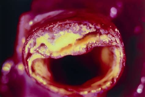 Atherosklerose Atherosklerose Msd Manual Profi Ausgabe