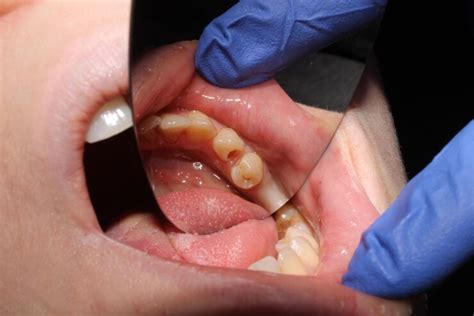 How Quickly Should A Tooth Abscess Be Treated