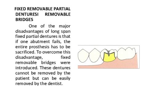TYPES OF BRIDGES A Fixed Partial Denture Is