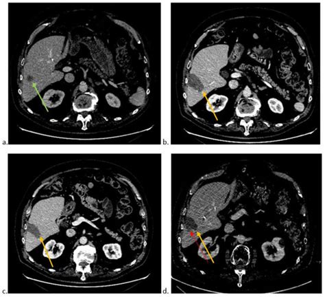 Predictive Factors Of Local Recurrence After Colorectal Cancer Liver Metastases Thermal Ablation