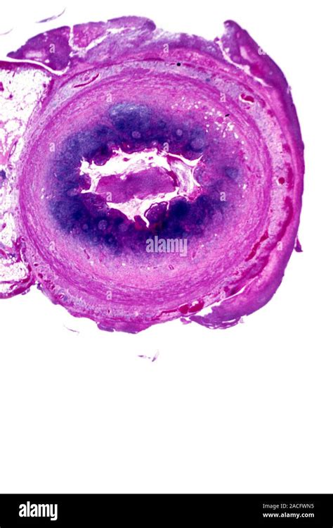 Acute Appendicitis Light Micrograph Through A Section Of An Appendix Showing Acute Appendicitis