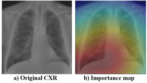 The Cxr Image Shows The Regions With Pneumonia In Both Lungs Download Scientific Diagram