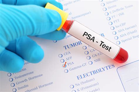 Psa En El Cáncer De Próstata Guía Completa Sobre El Antígeno