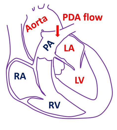Device Closure Of Pda All About Heart And Blood Vessels