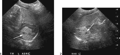 Sequestration Radiology Key