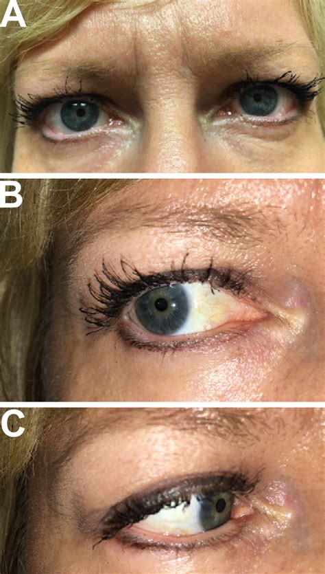 Millennialeye Visability Micro Insert System For Presbyopia