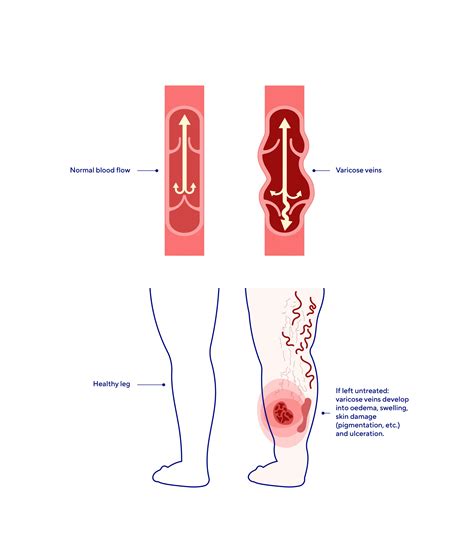 Venous Leg Ulcer Thuasne®