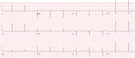 Hyperacute T Waves And Occlusion Mi Ecg Cases Emergency Medicine Cases