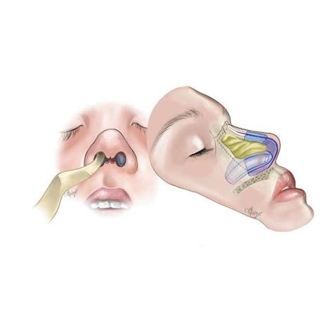 Doyle Internal Nasal Splint Pair Technomed India Private Limited