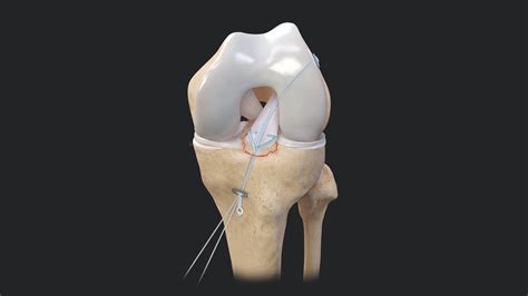 Arthrex Acl Repair Tightrope® Implant With Fiberring™ Sutures