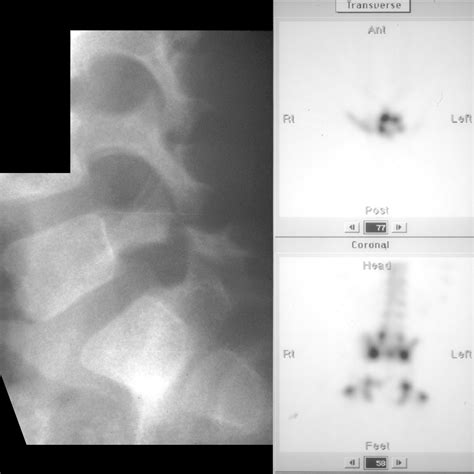 Pars Interarticularis Defect Pacs