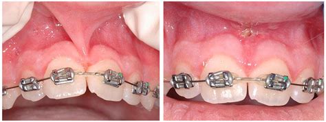 Labial Frenectomy Frenectomy Treat Lip Tie Or Tongue Tie